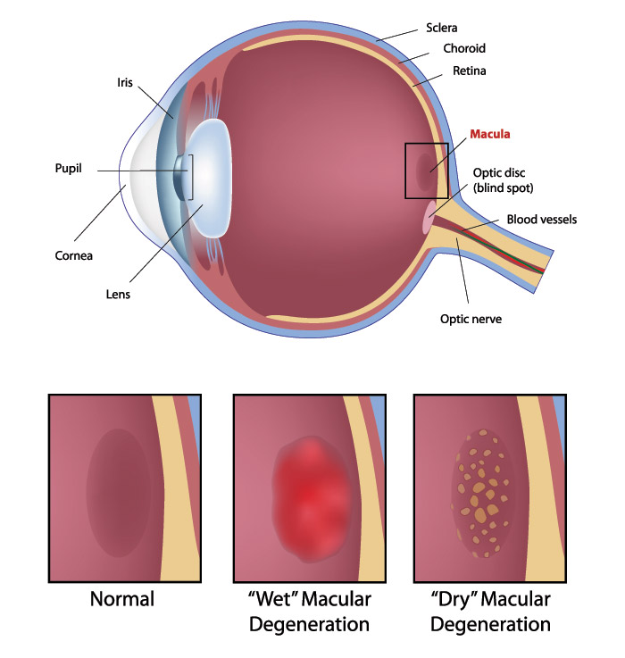 Retina Kingsport Macular Degeneration Kingsport Regional Eye